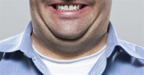 Fda Approves Kybella New Drug Treatment For Double Chins Cbs News