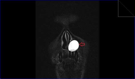 Epidermoid Cyst Mri Radiology Article On Mri Of Epidermoid Cysts