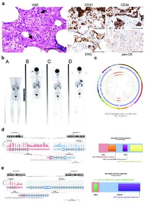 Analysis Of Case 130 A Ffpe Sections From Tumour 130 Were Assessed Download Scientific