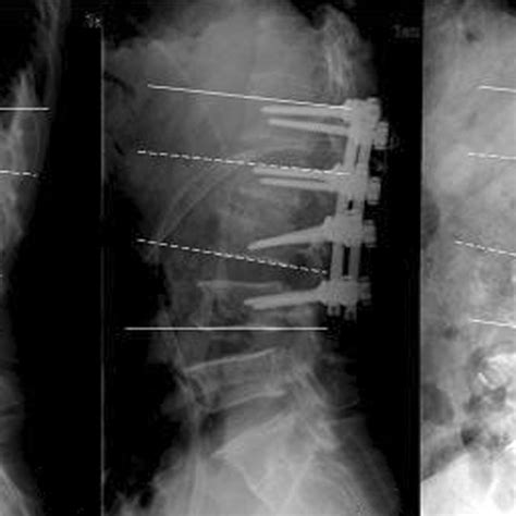 Pdf Management Of Lumbar Pyogenic Spondylitis With Posterior Decompression And Interbody