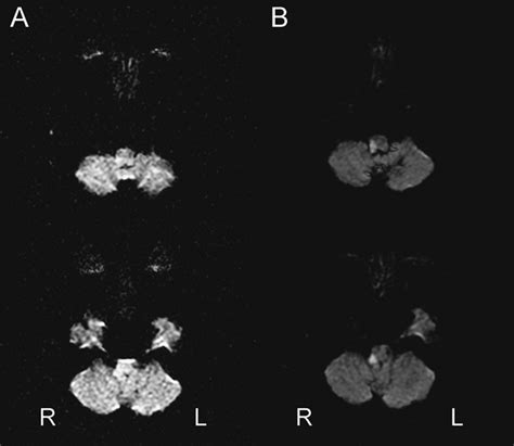 Diffusion Weighted Magnetic Resonance Images Dwis 7 Hours A And 31 Download Scientific