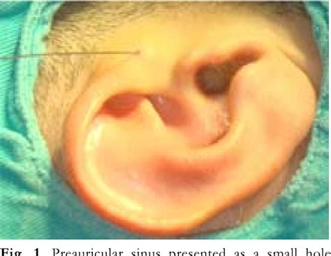 Figure 1 From The Preauricular Sinus Cyst A Case Report Semantic Scholar