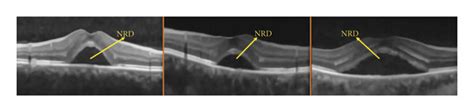 The Typical Lesion Characteristic Of Cscr Nrd Download Scientific