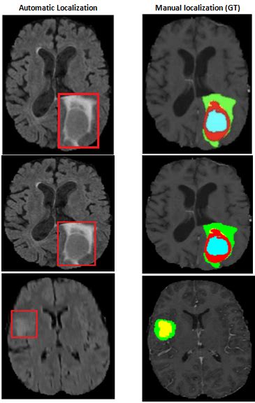 Sample Results Of Tumor Localization And Classification Download Scientific Diagram