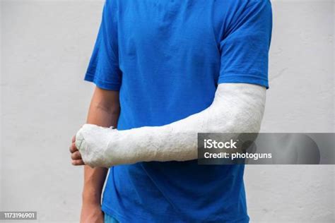 부러진 팔을 가진 남자는 의료 캐스트 석고를 감싸 스포츠 사고 후 손목 팔 팔꿈치를 덮는 유리 섬유 주조 흰색에 고립 건강관리와 의술에 대한 스톡 사진 및 기타 이미지