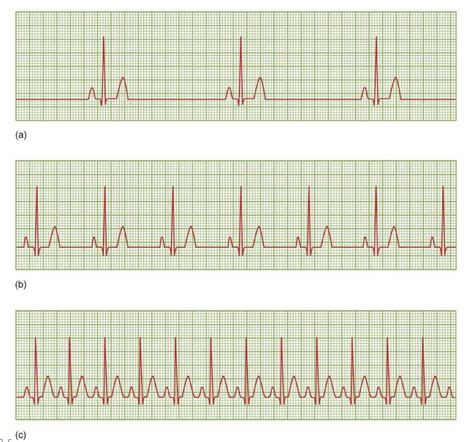 Tracing Of Ecgs Diagram Diagram Quizlet