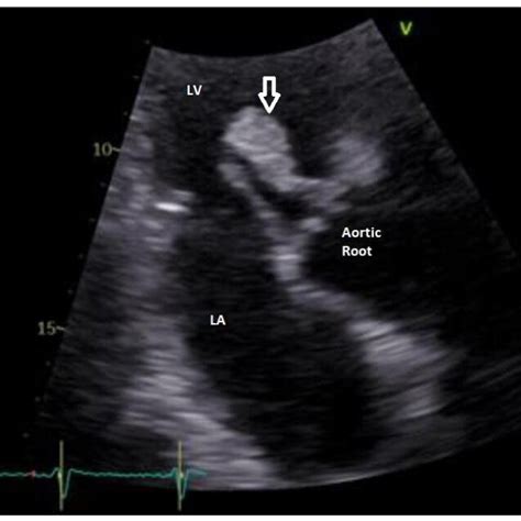 Transthoracic Echocardiography Tte Three Chamber Zoomed View