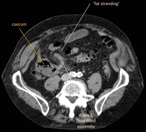 Bowel Pathology Radiology Cafe