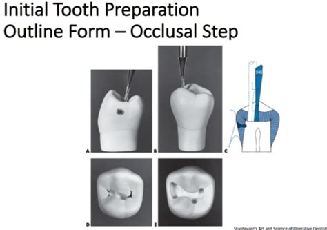 Week 1 Amalgam Class Ii Cavity Preparation Flashcards Quizlet