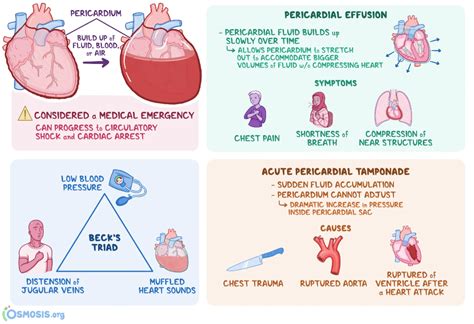 Pericardial Tamponade What Is It Causes Pericardial Effusion Signs