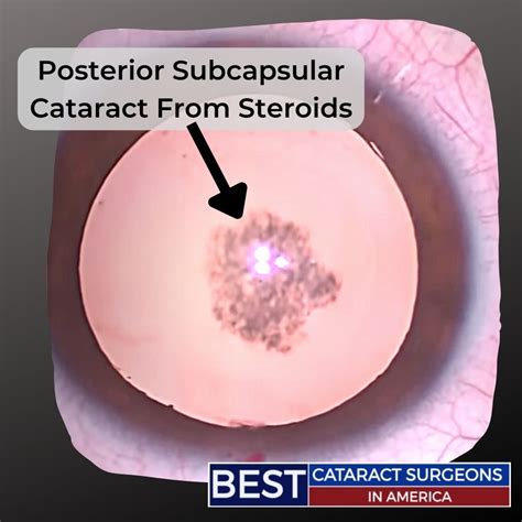 Causes Of Cataracts Understanding What Causes Cataracts