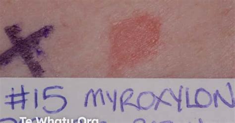 Positive Patch Test To Balsam Of Peru Image