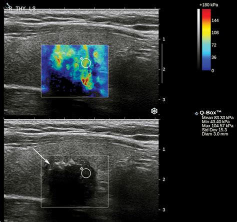 Thyroid Ultrasound Elastography Does Nodule Stiffness Predict