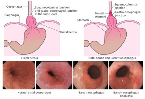 Esophagus Vs Endoscopy At Michael Birdwood Blog