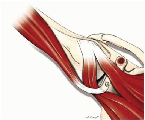 Arthroscopic Treatment Of Anterior Glenoid Bone Loss Latarjet Techniques Musculoskeletal Key