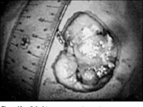 Figure 12 From Mesenchymal Non Epithelial Non Gist Tumors Of The Digestive Tract Semantic