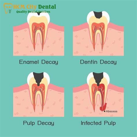 Toothache Abscess Relief Proven Home Remedies And Tips Dr Cuong Ho