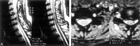 A And B Ct Myelograms The Reviewers Were Inconsistent In Judging Download Scientific Diagram