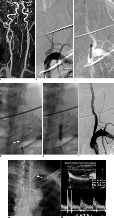 Placement Of Self Expanding Stent In 68 Year Old Man Who Presented Two Download Scientific
