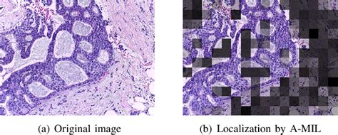 Breast Cancer Histopathology Image Classification And Localization Using Multiple Instance Learning