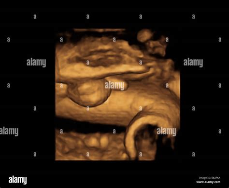 Triplets 3d Ultrasound