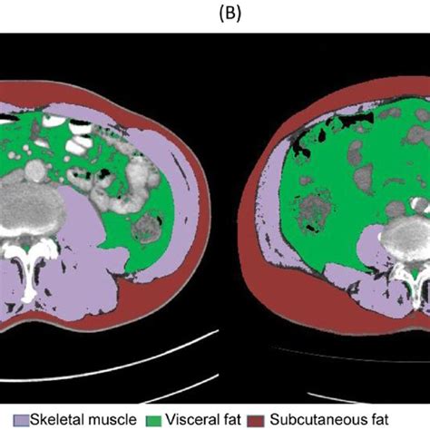 Cross Sectional Computed Tomography Of Two Patients Body Composition Download Scientific