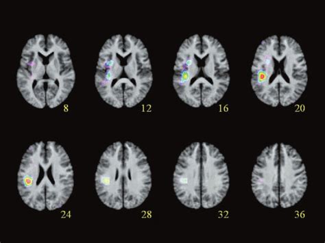 Statistical Parametric Map Of Response Difference Thresholded By P