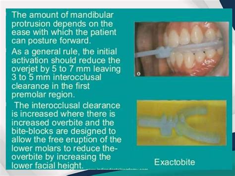 Twin Block Appliance In Orthodontics Pptx