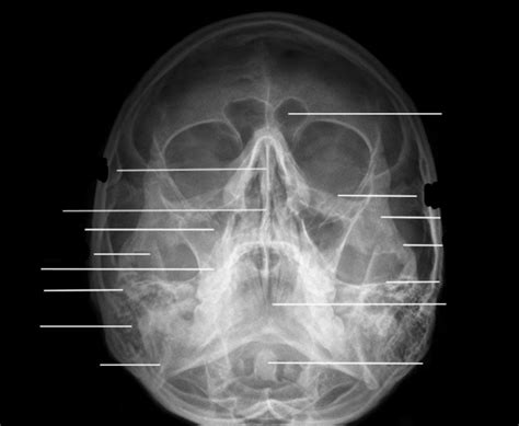 Facial Bone X Ray Anatomy Diagram Quizlet
