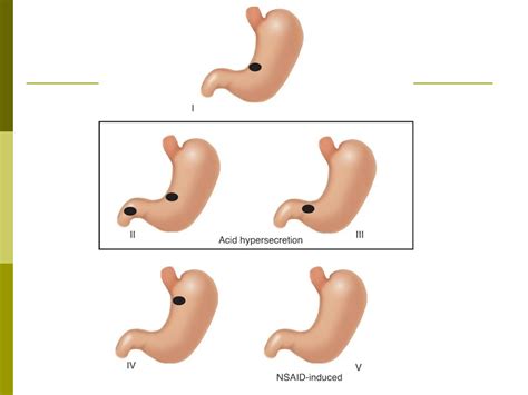 Peptic Ulcer Disease Pptx Duodenum Ulcer Ppt