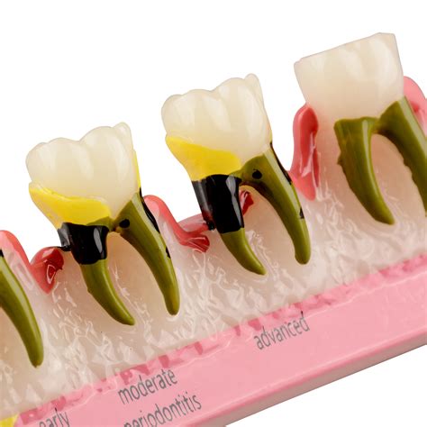Periodontal Disease Classification Model Manufacturer