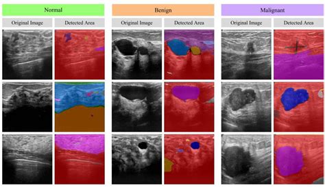 Figure 8 From Comparative Analysis Of Segment Anything Model And U Net For Breast Tumor