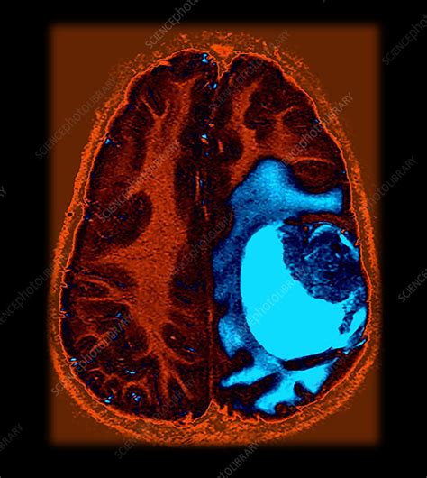 Colour Enhanced Primitive Neuroectodermal Tumour Pnet Mri Stock Image C043 3161 Science