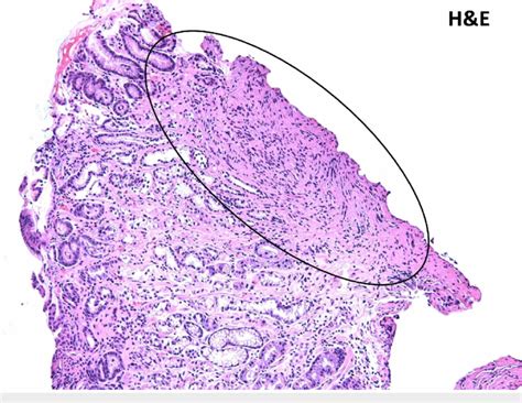 Histological Findings From The Gastric Biopsy Specimen Encircled Area