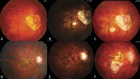 Retina