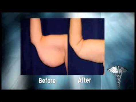 Brachioplasty Before And After Plastic Surgery YouTube