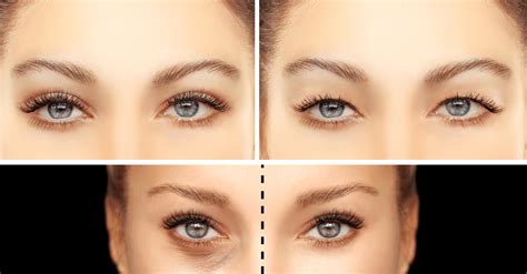 Eyelid Surgery In Mumbai Dr Anurag S Agarwal Eye Clinic