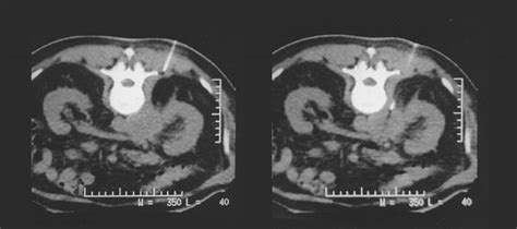 Near Real Time Ct Fluoroscopy Using Computer Automated Scan Technology