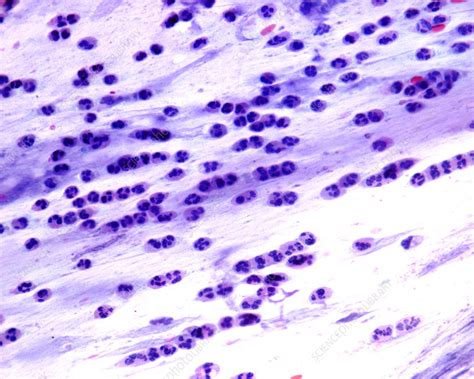 Sputum Smear In Acute Bronchitis Light Micrograph Stock Image C0595052 Science Photo Library