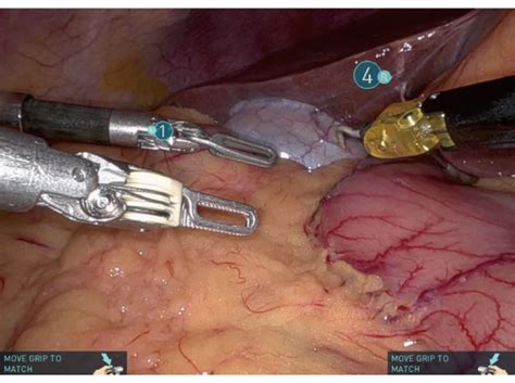 Application Of Robot Assisted Pancreaticobiliary Junction Resection In Benign Duodenal Tumors