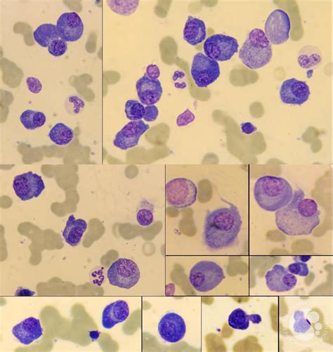 Plasma Cell Myeloma 4