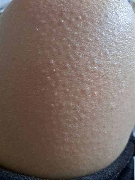 피부 오돌토돌 가려움 지식in