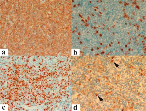 Ihc Staining Of T Lbl ·200 A Lymphoblasts Show Cytoplasmic Cd3