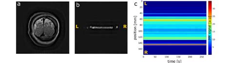 A Acquired Slice With Spin Echo Sequence B Lsd Image For Seline