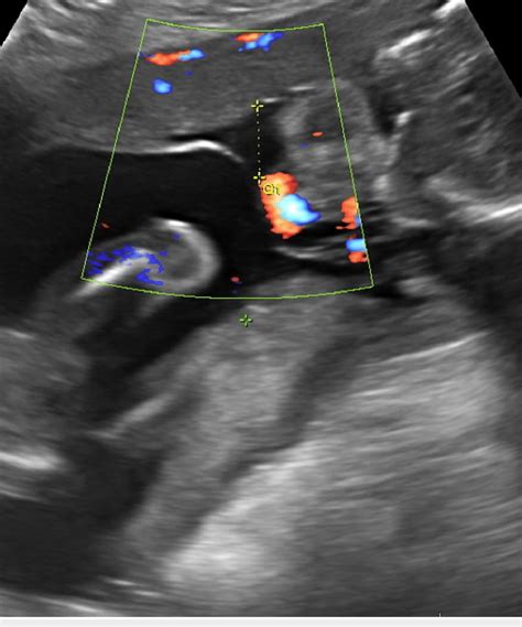 Diamniotic Dichorionic Twin Pregnancy At 19 Weeks And 4 Days Gestation Download Scientific