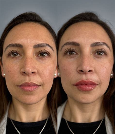 Botox® 3 Zonas Relleno De Labios Clínica Estétika Médica