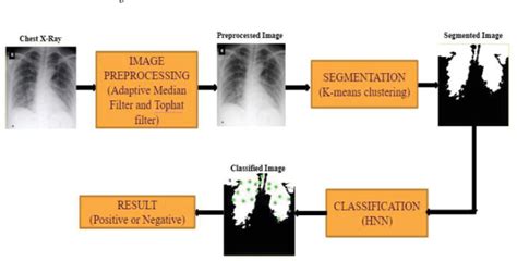 Figure 3 From Detection Of Pneumonia By Binary Image Classification Using Hybrid Neural Networks