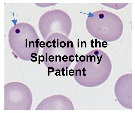 Emergency Medicine Educationdangers Of Infection In The Splenectomy Patient