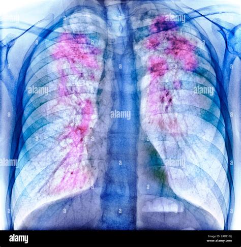 Sarcoidosis Frontal Coloured Chest X Ray Of The Lungs Of A 52 Year Old Man With Pulmonary