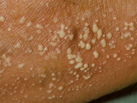 Psoriasis Help 4 Friends Common Signs And Symptoms Of Psoriasis